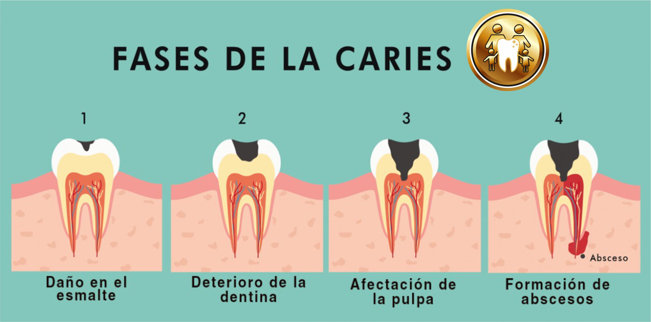 Caries Dental Etapas Tempranas Tipos De Caries Dentales | Clínica